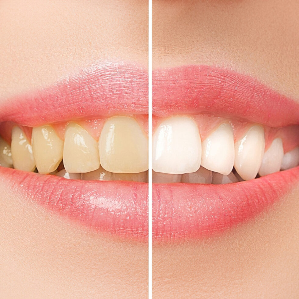 Teeth Whitening - Richrose Dental